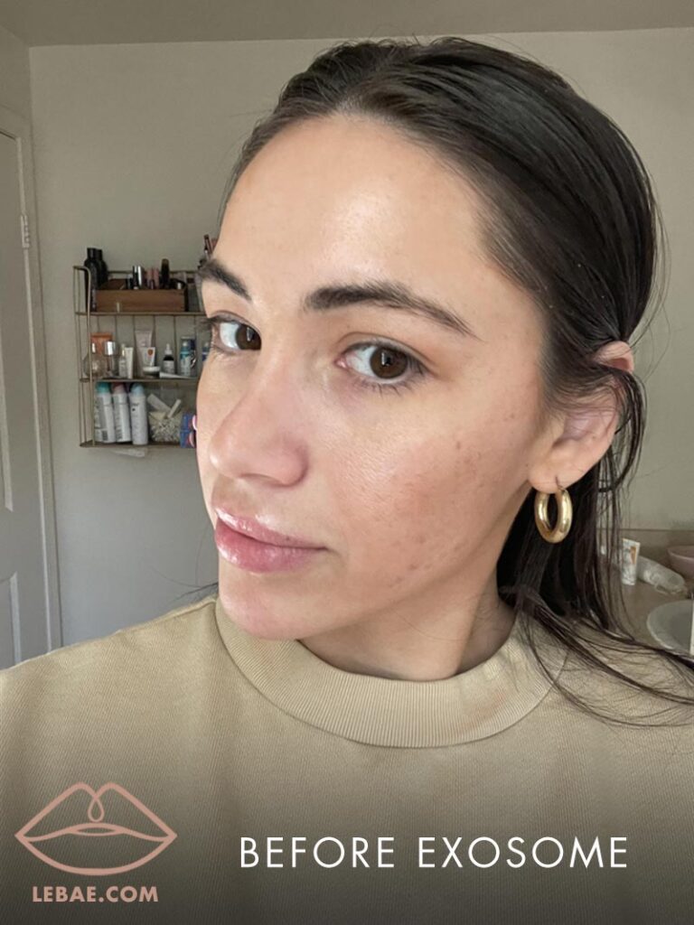 Exosomes Therapy Los Angeles, Orange County - Lebae