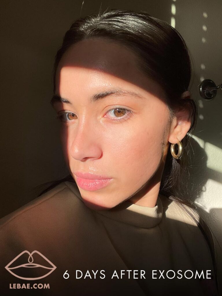 Exosomes Therapy Los Angeles, Orange County - Lebae